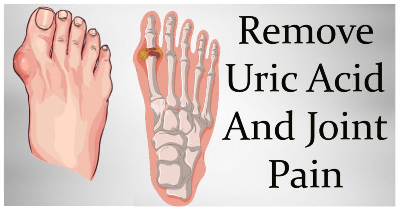 How To Remove Gout and Joint Pain (Uric Acid and Crystals) - My Amazing ...